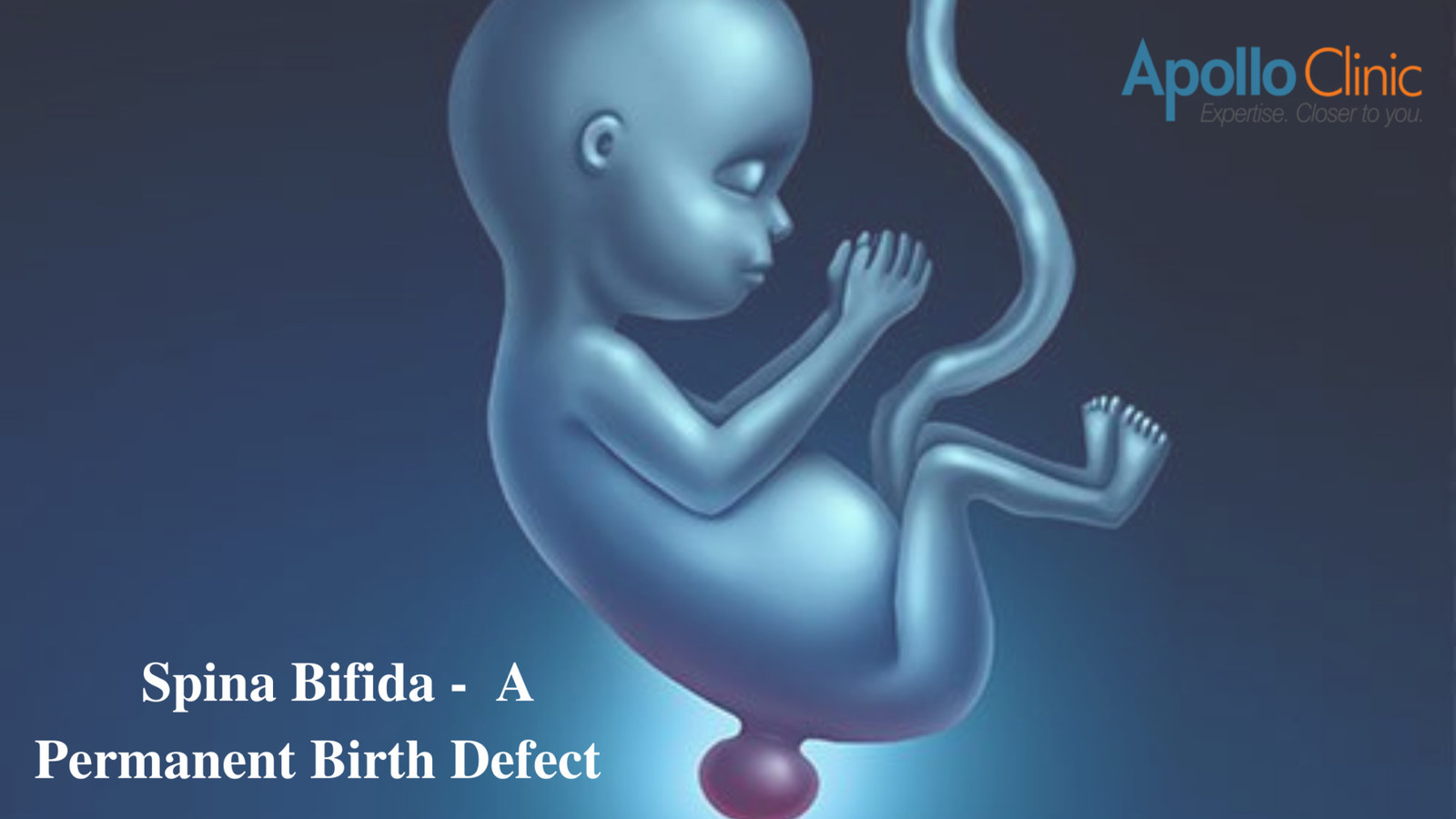 Spina Bifida: A Permanent Birth Defect | Apollo Clinic